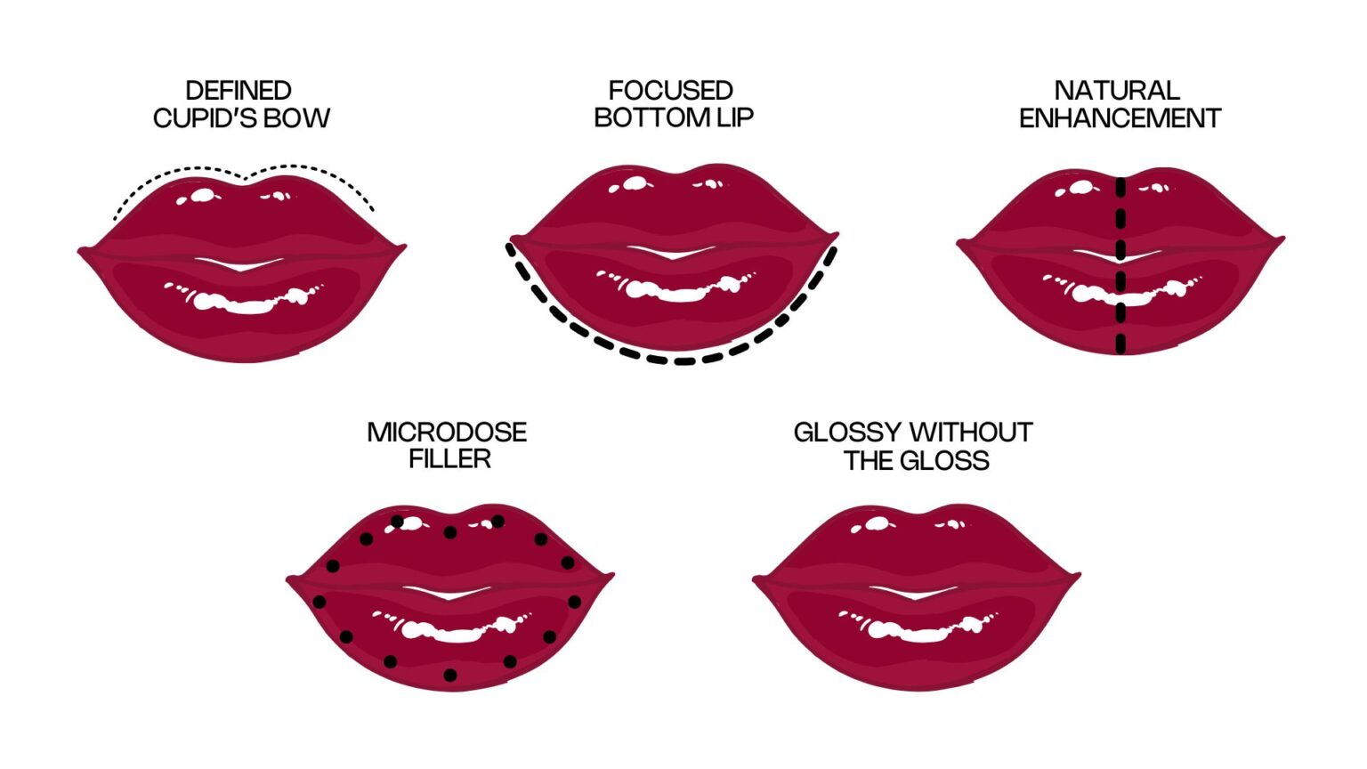 Top Lip Injection Trends and Techniques for 2025: Find Your Ideal Lip ...